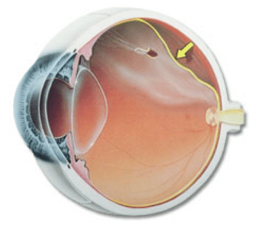 O que é e qual a causa do descolamento de retina? - Clínica Roisman